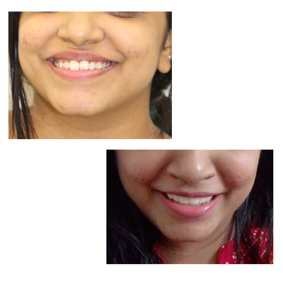 A Bride’s Perfect Smile Makeover at Opal Dentistry | Opal Dentistry